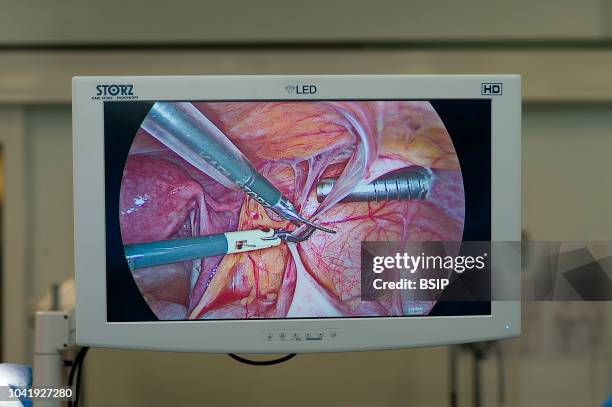 Laparoscopic Surgery Endometriosis Photos and Premium High Res Pictures ... Laparoscopic Surgery Endometriosis Photos and Premium High Res Pictures ...
