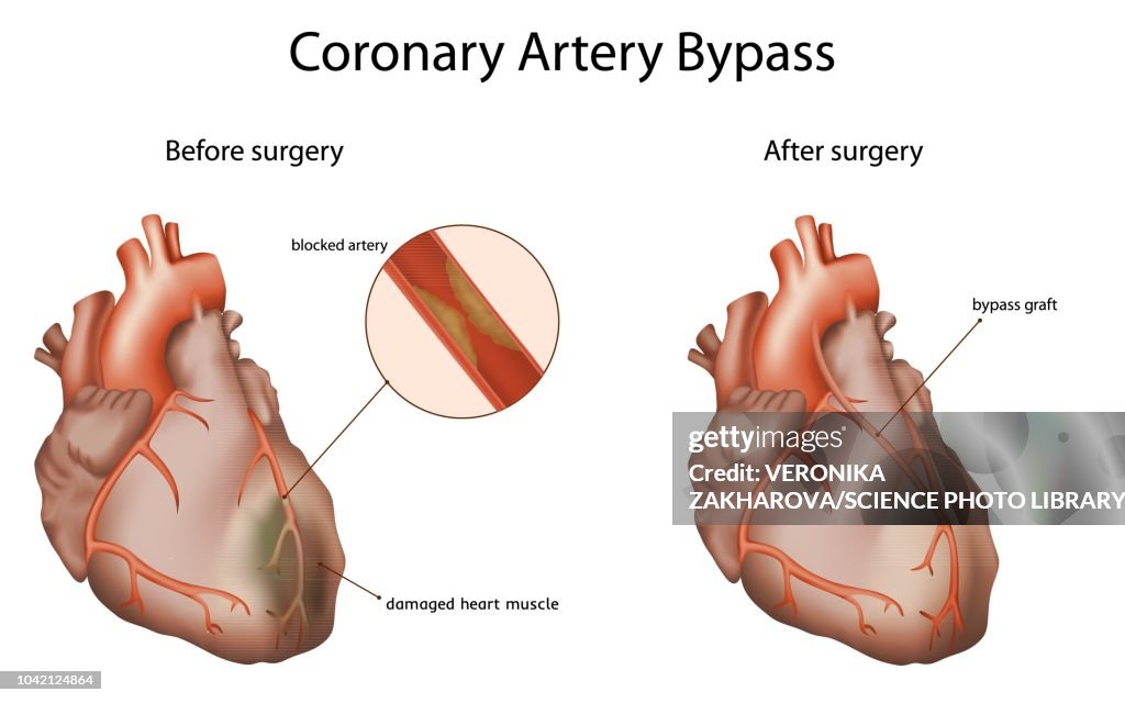 Coronary Artery Bypass Illustration High-Res Vector Graphic - Getty Images Coronary Artery Bypass Illustration High-Res Vector Graphic - Getty Images