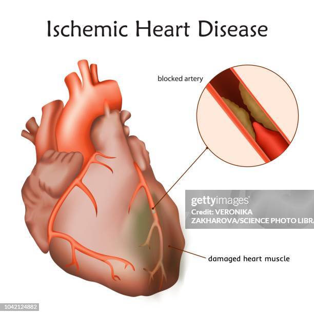 Ischemic Heart Disease Photos And Premium High Res Pictures Getty Images