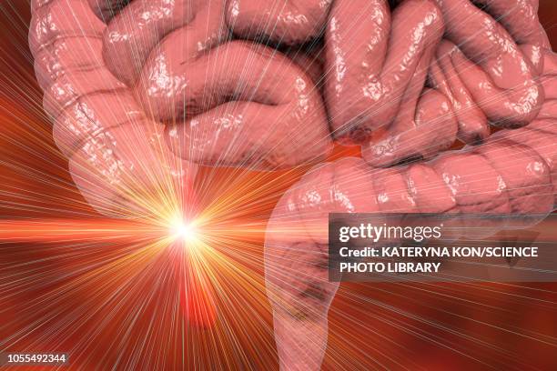 Appendicitis Surgery High Res Illustrations Getty Images