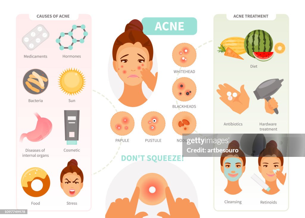 Acne Infographic Vector High Res Vector Graphic Getty Images