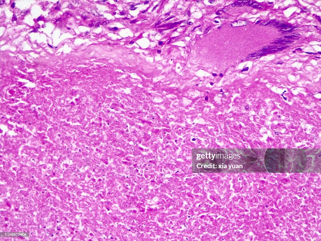 Caseous Necrosis Lymph Node Caseous Necrosis Lymph Node