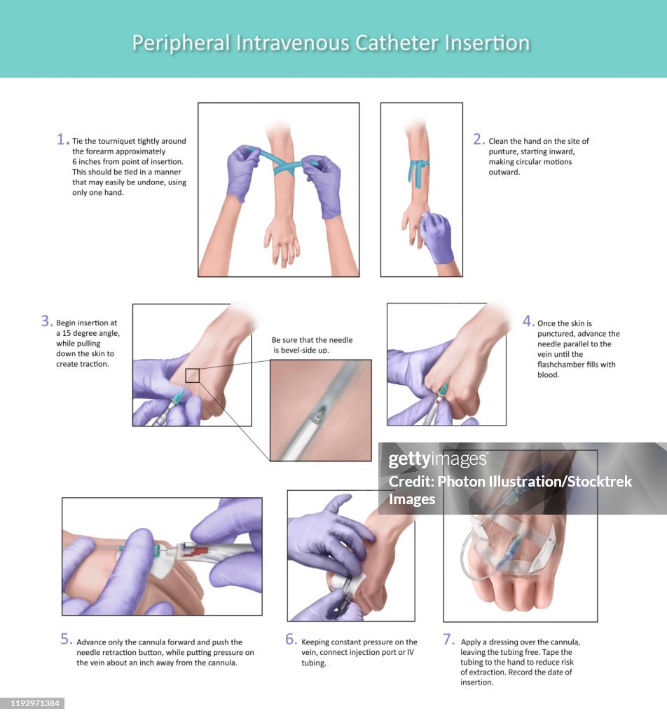 Intravenous Catheter Insertion Intravenous Catheter Insertion