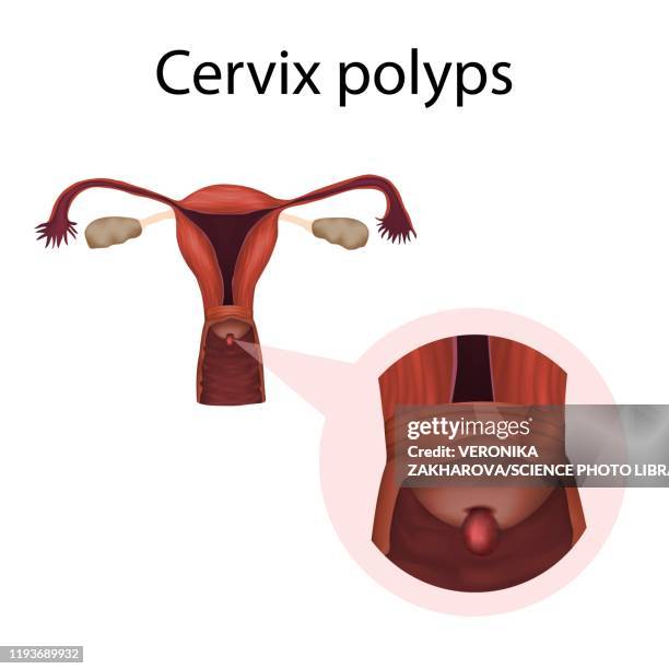 Uterine Polyps Photos And Premium High Res Pictures Getty Images