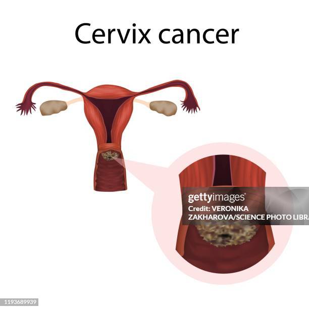 Cervical Cancer Screening Photos And Premium High Res Pictures Getty