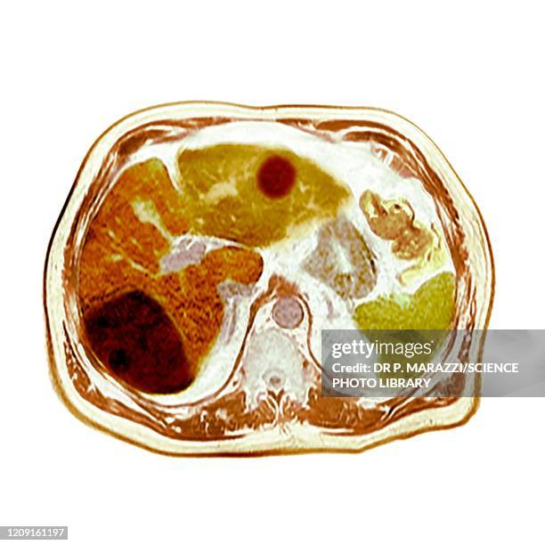 Ct Scan Liver Stock Fotos Und Bilder Getty Images