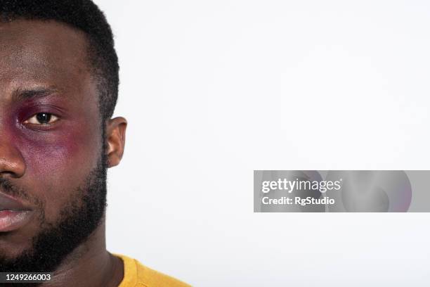 Bruise On Face Photos And Premium High Res Pictures Getty Images