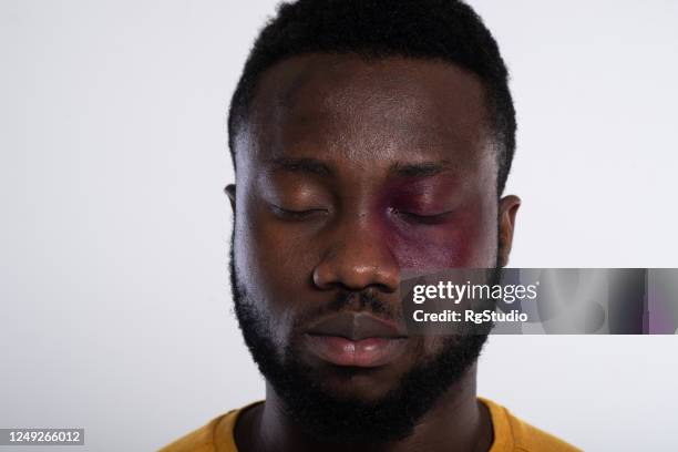 Bruise On Face Photos And Premium High Res Pictures Getty Images