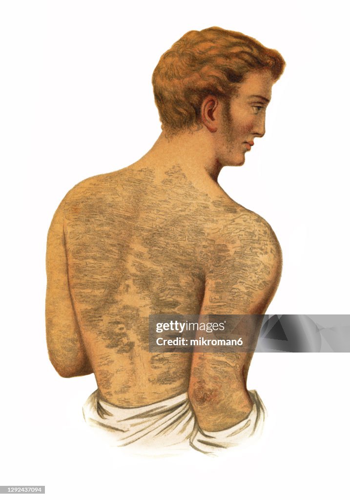 Old Engraved Illustration Of Skin Diseases Ichthyosis High Res Stock