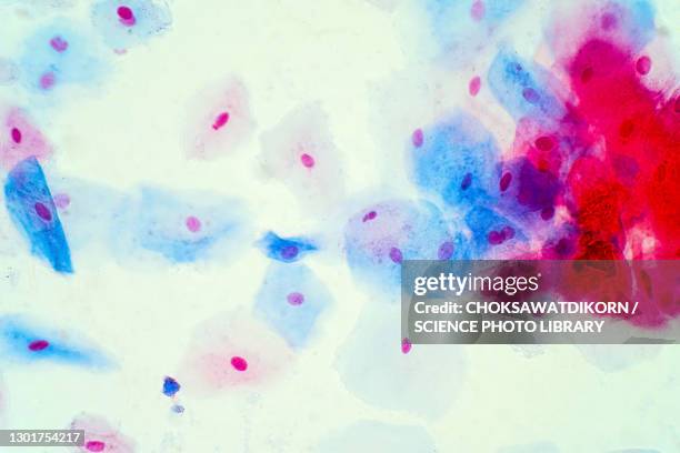 Squamous Cell Stock Fotos Und Bilder Getty Images