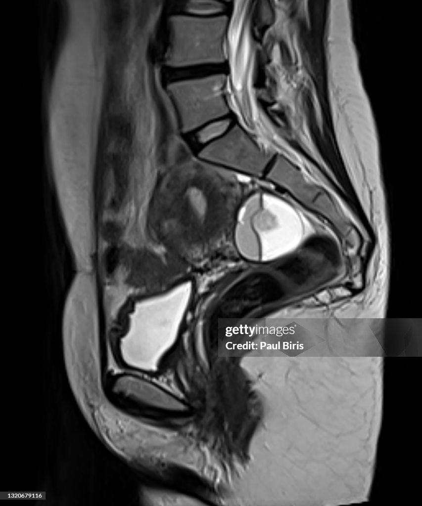 Ovarian Dermoid Cyst
