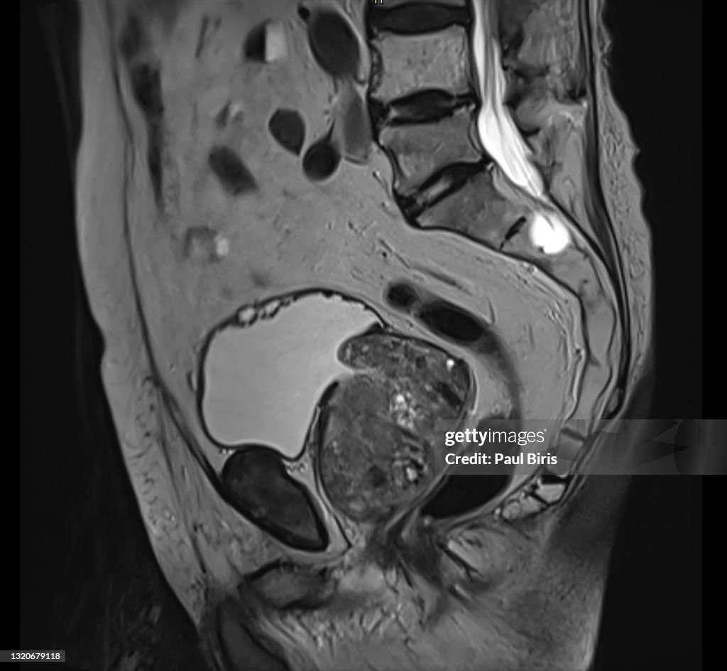 Benign Prostatic Hyperplasia Or Prostate Adenoma Seen On Mri Examination Sagital T2 Image High