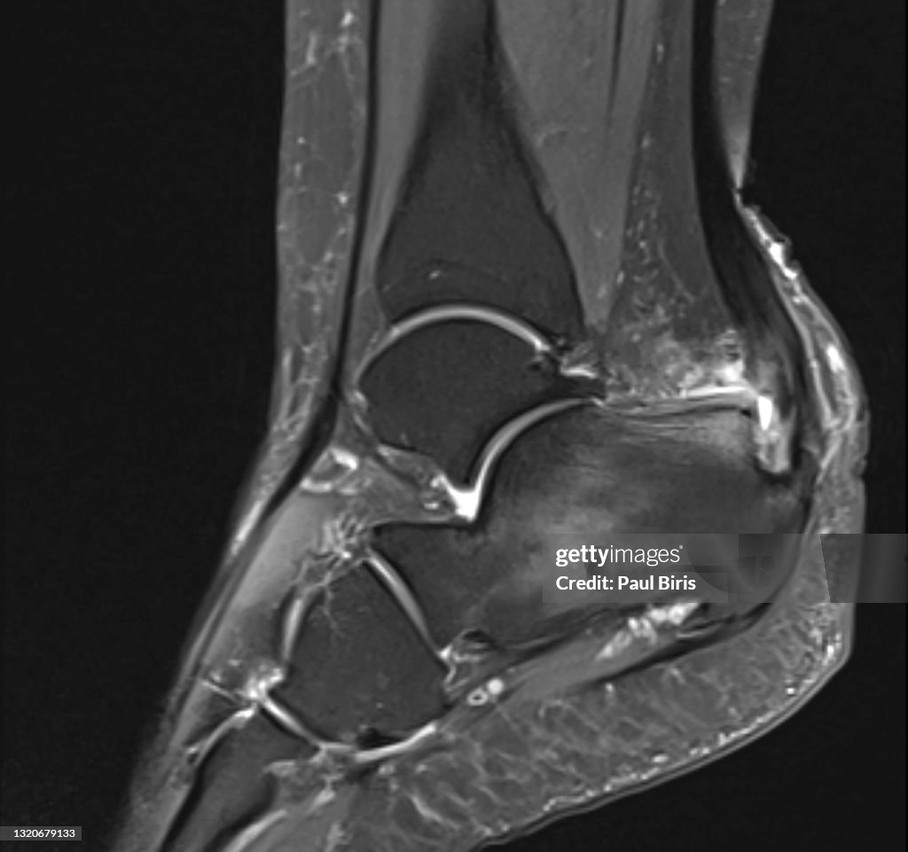 Haglund Triad Seen On Mri Image Insertional Achilles Tendinopathy Retrocalcaneal Bursitis And