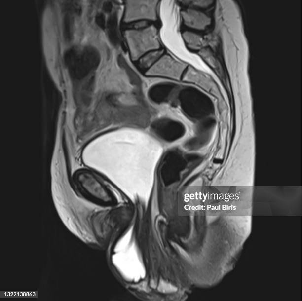 Cystocele Photos And Premium High Res Pictures Getty Images