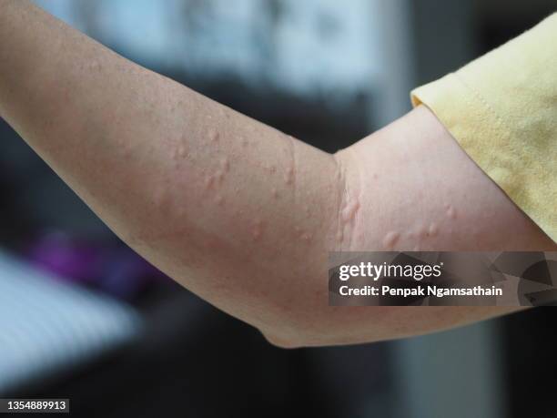 Rash On Upper Arm