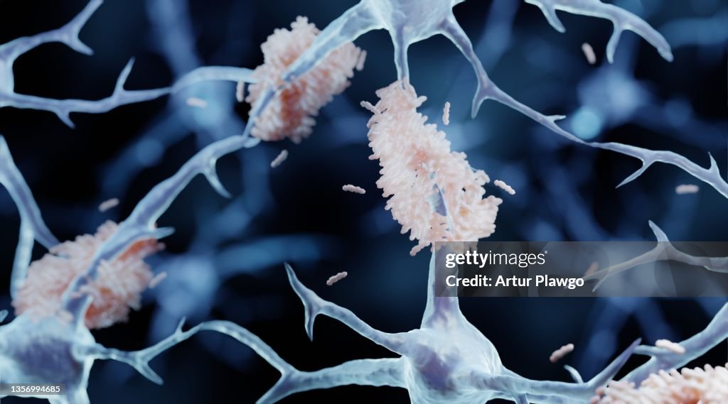 Amyloid Plaques In Alzheimers Disease High-Res Stock Photo - Getty Images Amyloid Plaques In Alzheimers Disease High-Res Stock Photo - Getty Images