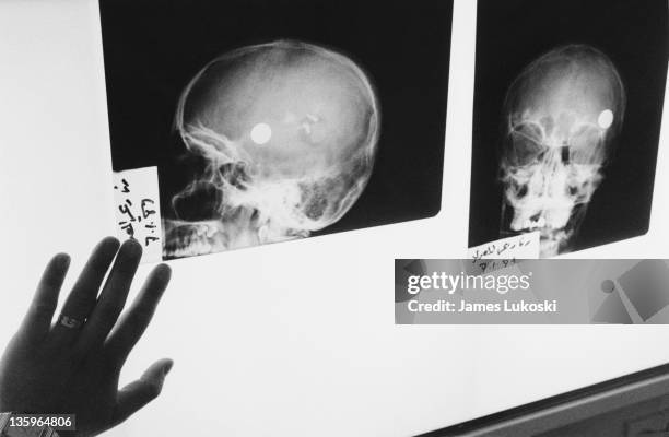 39 X Ray Foreign Body Stock Photos, High-Res Pictures, and Images ... 39 X Ray Foreign Body Stock Photos, High-Res Pictures, and Images ...