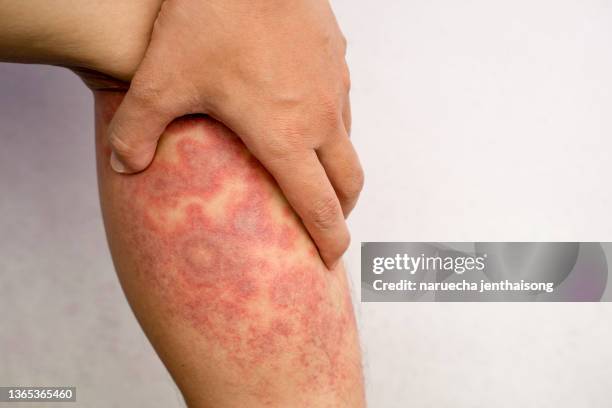 Atopic Dermatitis Leg Photos And Premium High Res Pictures Getty Images