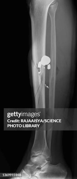 41 X Ray Foreign Body Stock Photos, High-Res Pictures, and Images ... 41 X Ray Foreign Body Stock Photos, High-Res Pictures, and Images ...