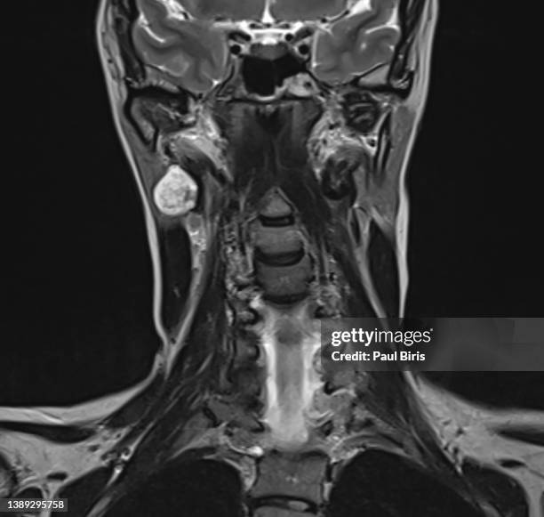 Parotid Gland Photos And Premium High Res Pictures Getty Images