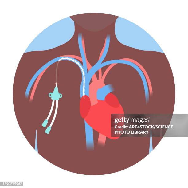 38 Central Venous Access Devices Stock Photos, High-Res Pictures, and ... 38 Central Venous Access Devices Stock Photos, High-Res Pictures, and ...