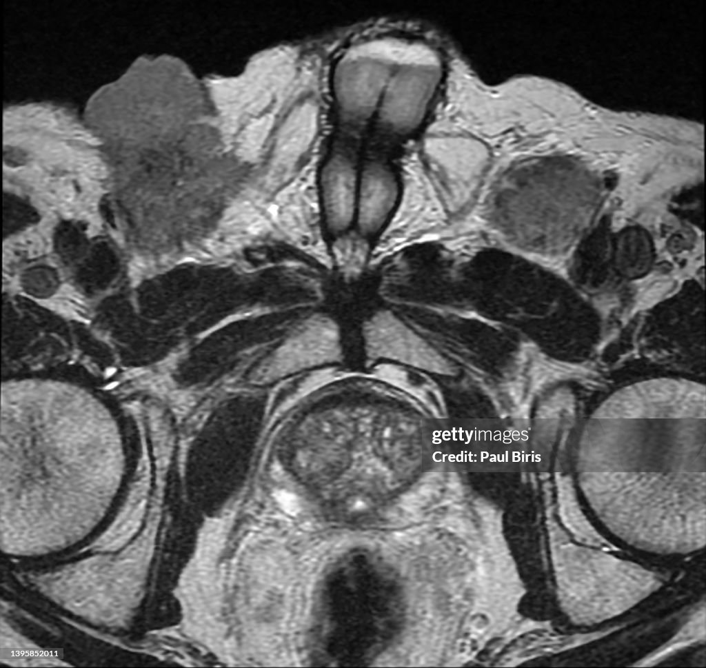 Inguinal Lymphadenopathy Swollen Lymph Nodes In Groin Seen On Mri Axial T2 Image High Res Stock