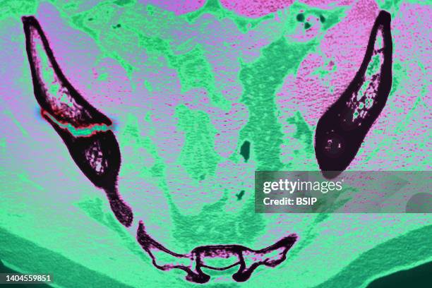 Pelvic Fractures Photos And Premium High Res Pictures Getty Images