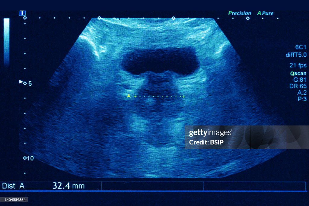 Prostate Ultrasound To Visualize The Volume And Structure Of The