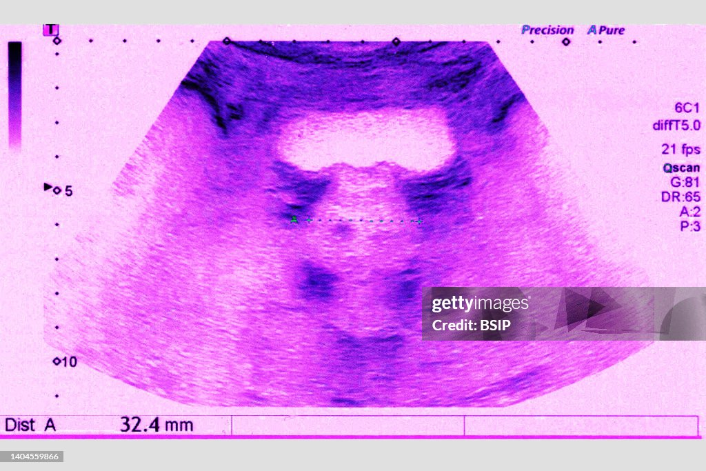 Prostate Ultrasound To Visualize The Volume And Structure Of The