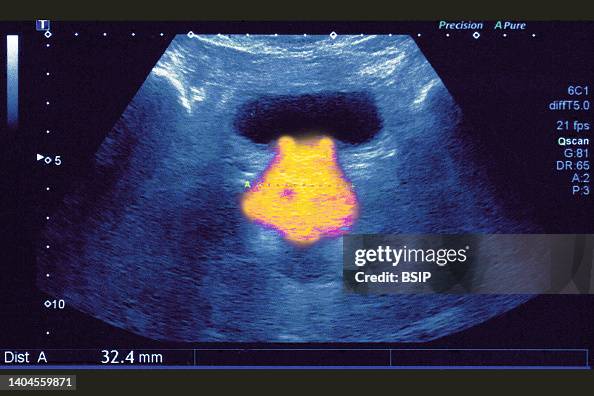 Prostate Ultrasound To Visualize The Volume And Structure Of The