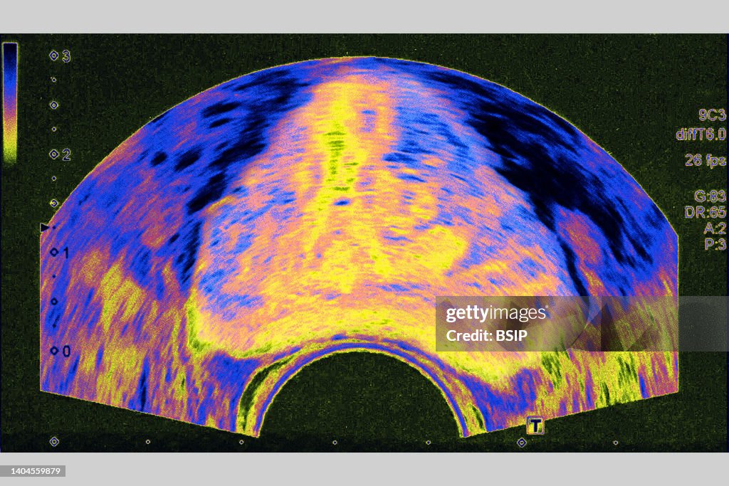 Prostate Ultrasound To Visualize The Volume And Structure Of The