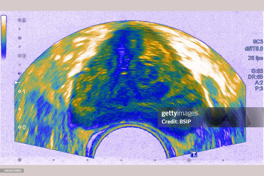 Prostate Ultrasound To Visualize The Volume And Structure Of The