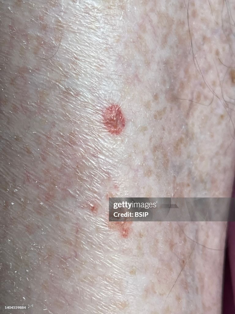 Onset of psoriasis on the leg of a 70-year-old man. News Photo - Getty ... Onset of psoriasis on the leg of a 70-year-old man. News Photo - Getty ...