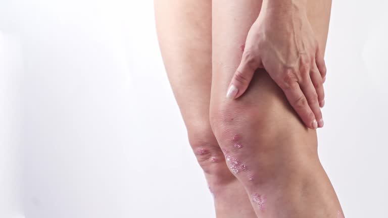 Psoriatic Arthritis With Skin Psoriasis On A Womans Knees Synovial Fluid In A Patient With