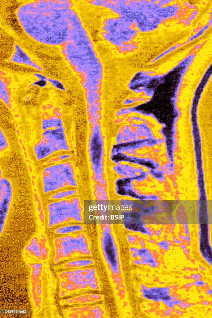 Multiple Sclerosis Mri Of The Cervical Vertebrae In Sagittal News Photo Getty Images