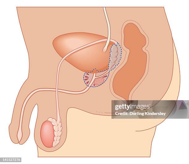 Radical Prostatectomy Photos And Premium High Res Pictures Getty Images