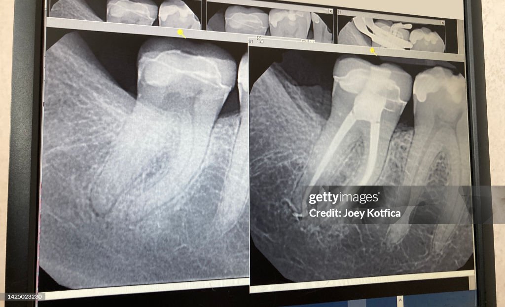 Digital Dental Xrays For A Root Canal Dental Procedure At An Endodontists Office High Res Stock