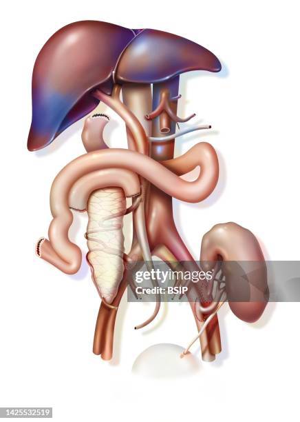 60 Kidney Pancreas Transplant Stock Photos, High-Res Pictures, and ... 60 Kidney Pancreas Transplant Stock Photos, High-Res Pictures, and ...