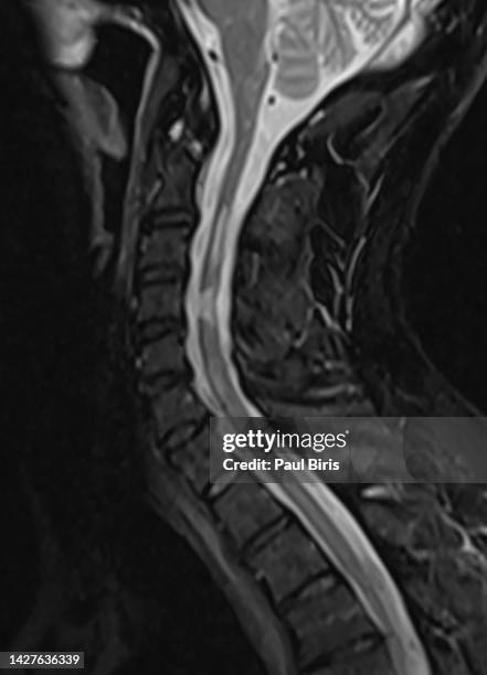 Cervical Lesions Photos And Premium High Res Pictures Getty Images