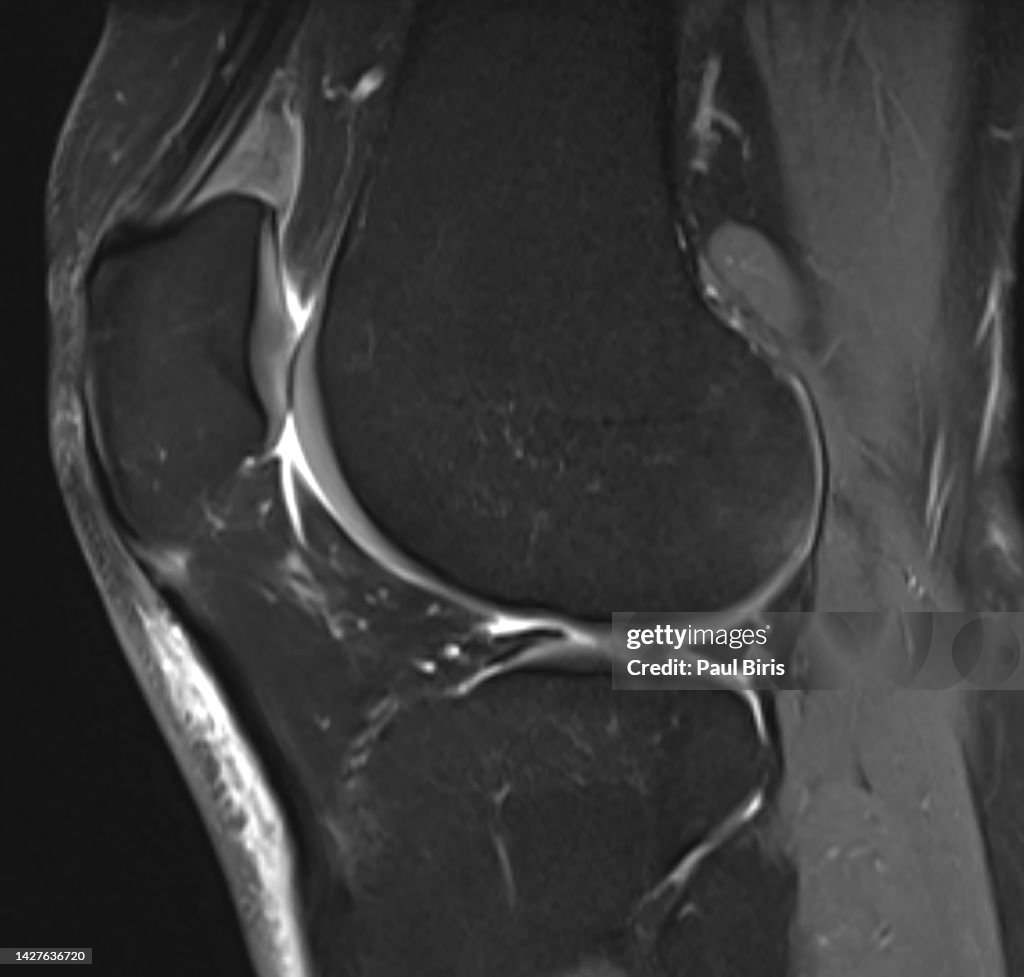 Anterior Suprapatellar Fat Pad Impingement Syndrome Sagital T2 Fat Sat Mri Image Quadriceps