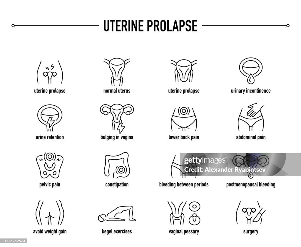 Uterine Prolapse Vector Icon Set High Res Vector Graphic Getty Images