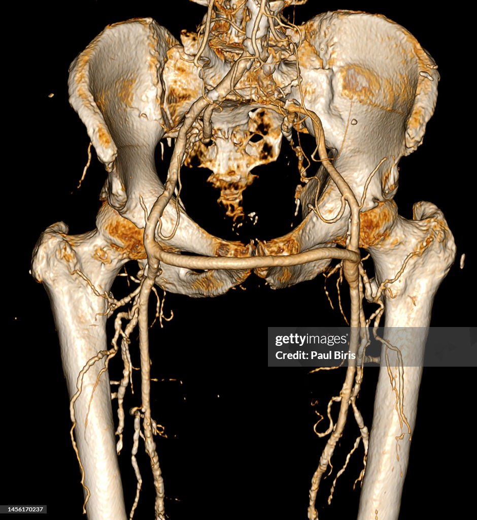 Femorofemoral Bypass Technique Seen On 3d Ct Reconstruction Foto de ... Femorofemoral Bypass Technique Seen On 3d Ct Reconstruction Foto de ...