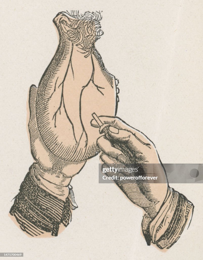 Medical Illustration Of Hydrocele Testis Being Tapped With Trocar 19th