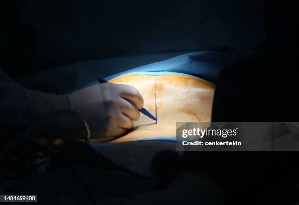 Comprehensive Guide to Gastric Sleeve Surgery in Istanbul