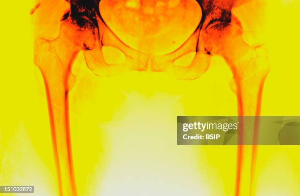 Arthritis Of The Hip X Ray Photos And Premium High Res Pictures Getty Images