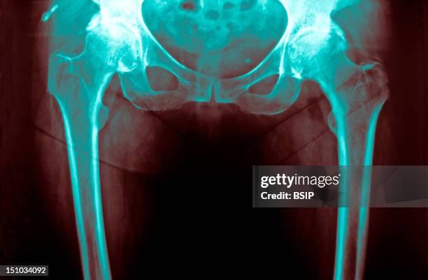 Arthritis Of The Hip X Ray Photos And Premium High Res Pictures Getty Images