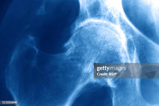 Arthritis Of The Hip X Ray Photos And Premium High Res Pictures Getty Images