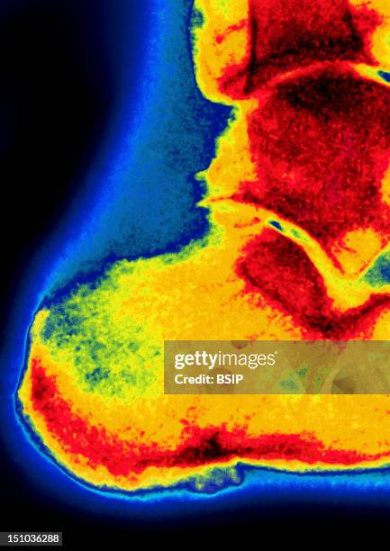 Exostosis Photos And Premium High Res Pictures Getty Images