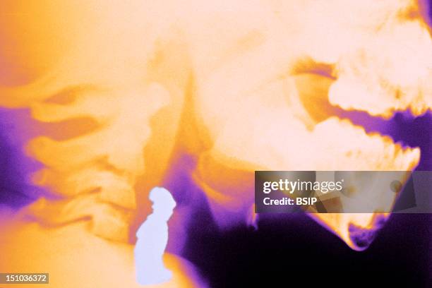 41 X Ray Foreign Body Stock Photos, High-Res Pictures, and Images ... 41 X Ray Foreign Body Stock Photos, High-Res Pictures, and Images ...
