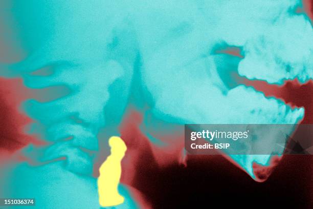 X Ray Foreign Body Photos And Premium High Res Pictures Getty Images
